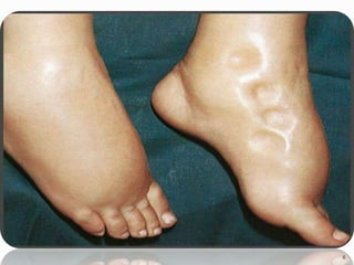Edema ppt | PPTX