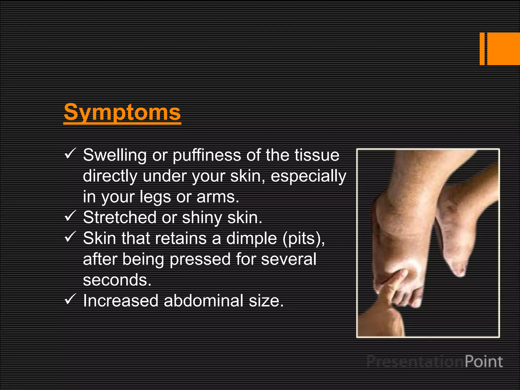 Edema..ppt
