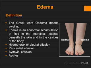 Edema..ppt