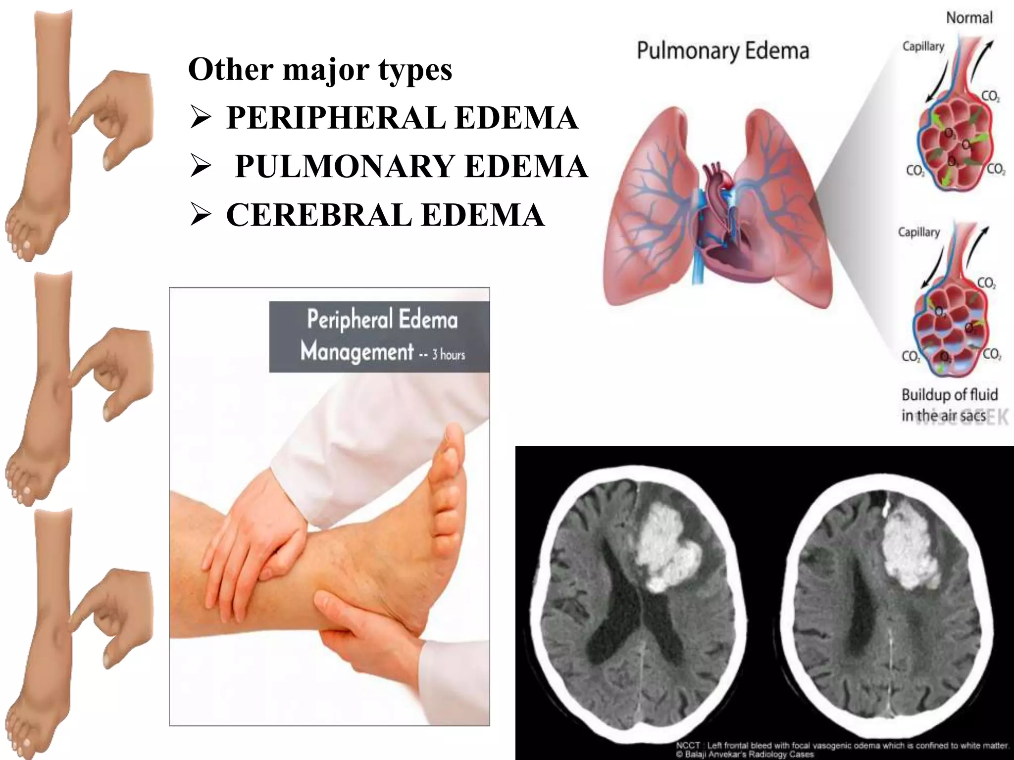 Edema | PPTX | Blood Disorders | Diseases and Conditions