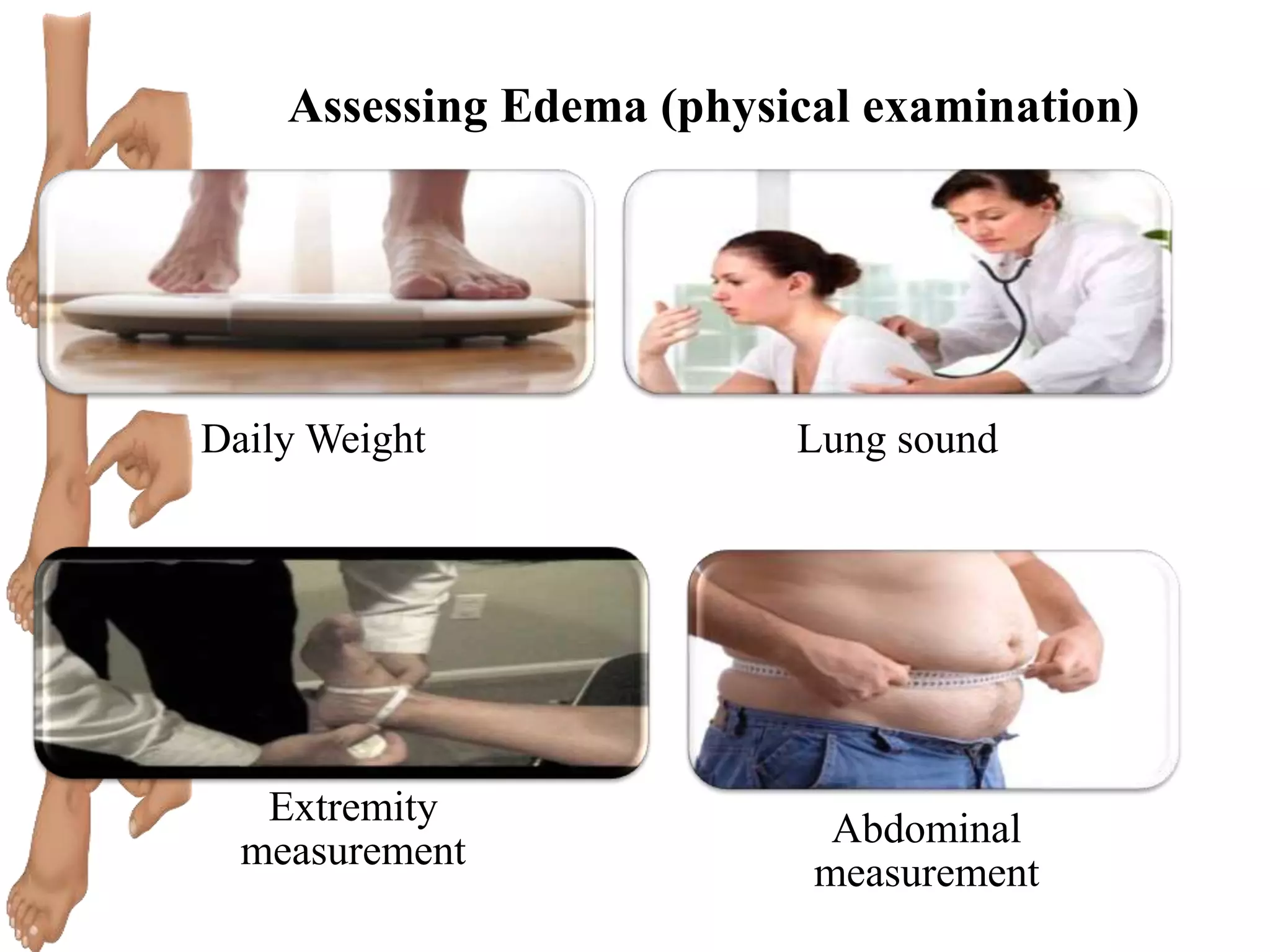 Edema | PPTX | Blood Disorders | Diseases and Conditions