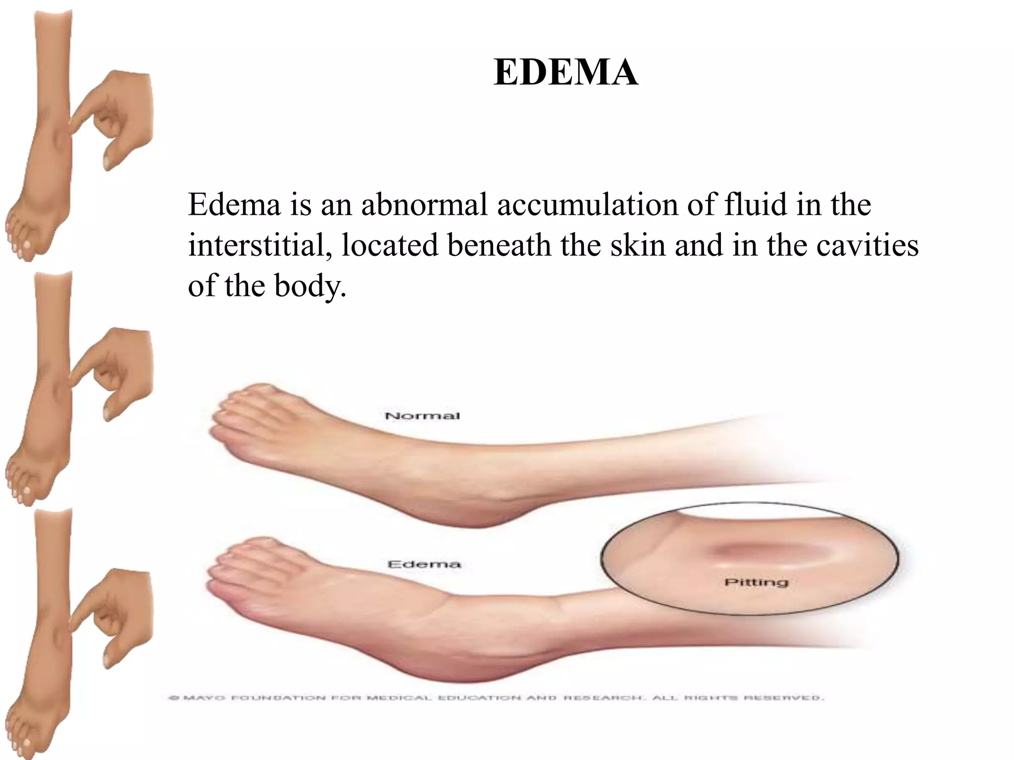 Edema | PPTX