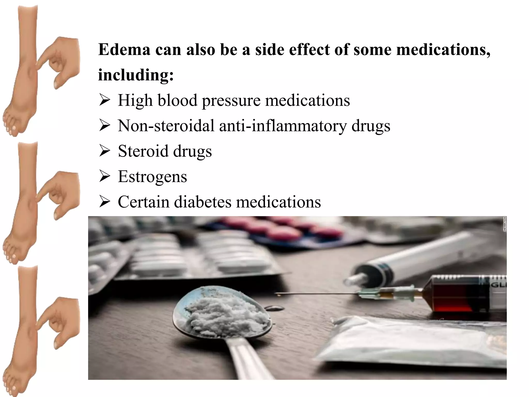 Edema | PPTX