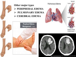 Edema | PPTX