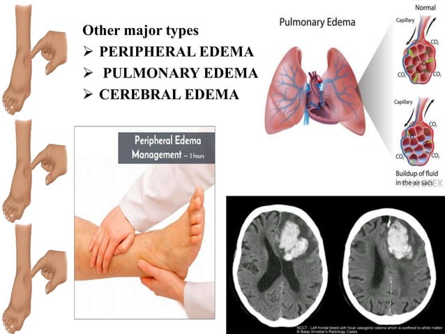 Edema | PPTX | Blood Disorders | Diseases and Conditions