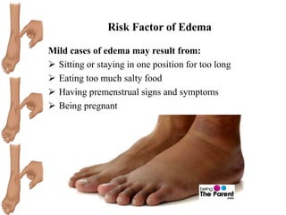 Edema | PPTX