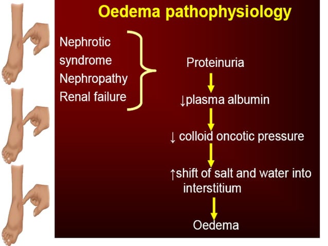 Edema | PPTX | Blood Disorders | Diseases and Conditions