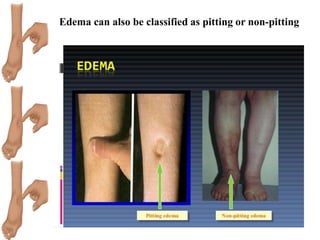 Pitting Edema In Dogs