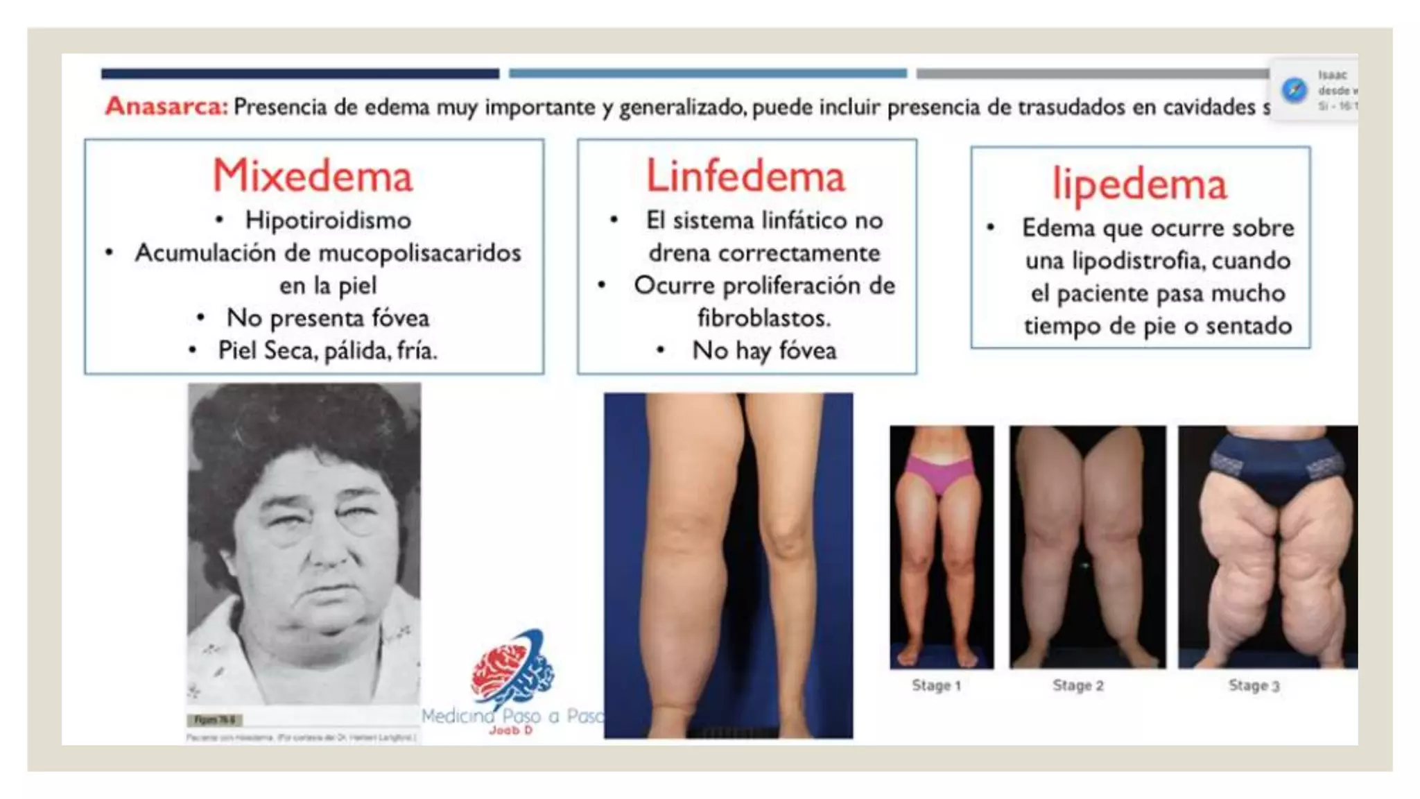 Semiologia: Edema | PPTX