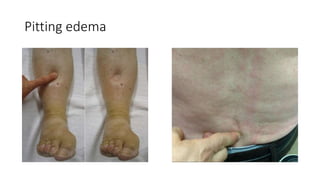 Approach to Pedal Edema (for undergraduates) | PPTX