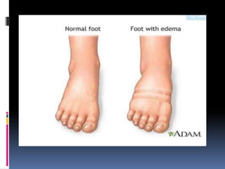 Edema | PPTX