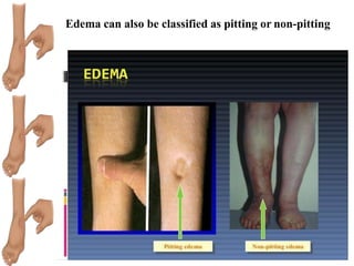 Edema | PPT