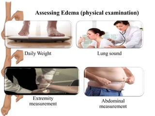 Edema | PPTX