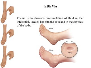 Edema | PPTX