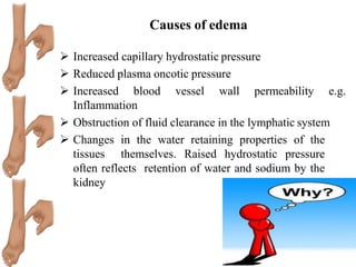 Edema | PPT