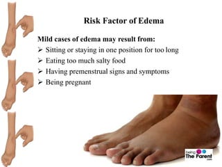 Mild Edema