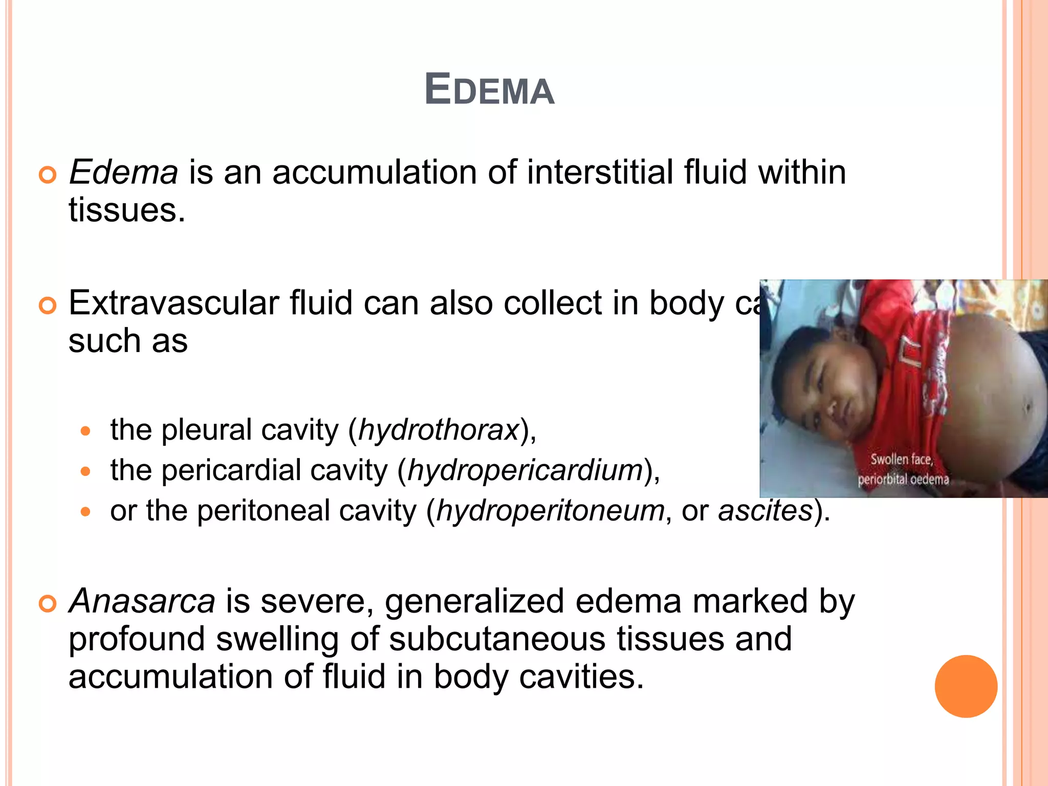 Edema | PPTX