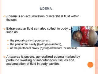 Edema | PPTX
