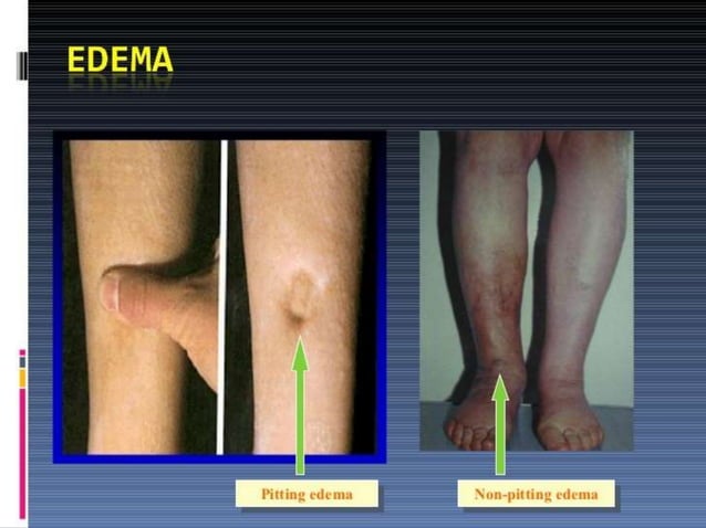 Edema | PPTX