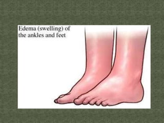 edema-210412060249.pdf