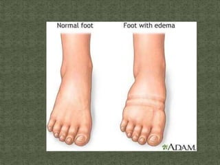 edema-210412060249.pdf