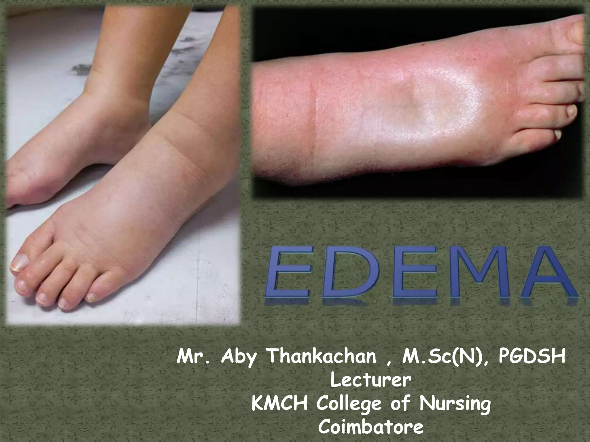 Edema Diagram For Nursing Process Steps