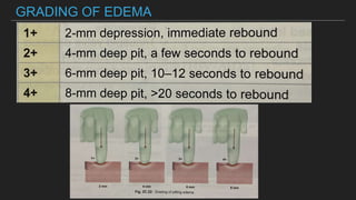 Edema | PPTX