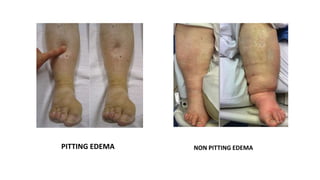 edema.pptx