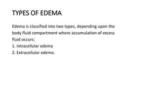 edema.pptx