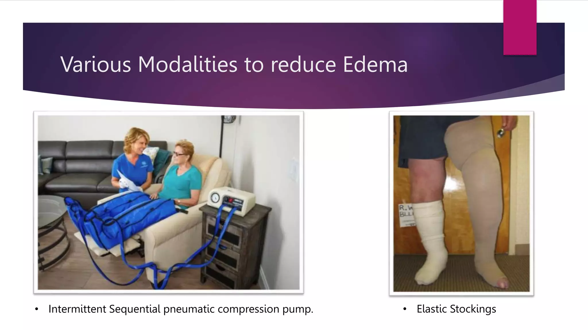 edema .pptx