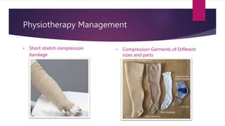 edema .pptx