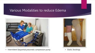 edema .pptx