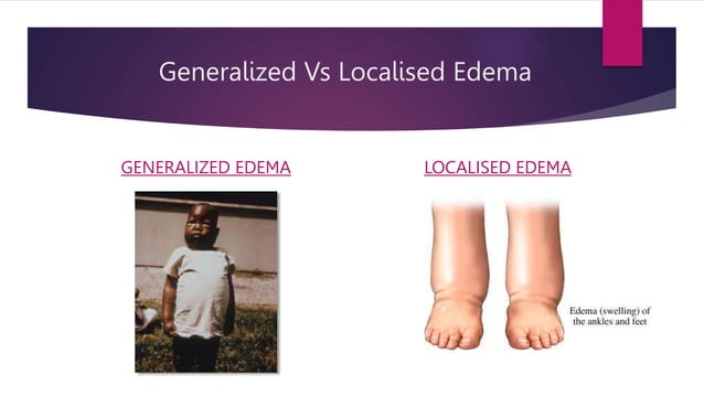 edema .pptx
