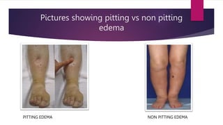 edema .pptx