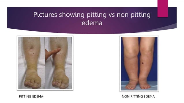 edema .pptx