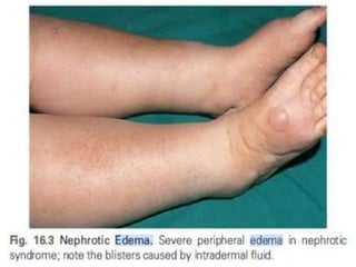 edema ...