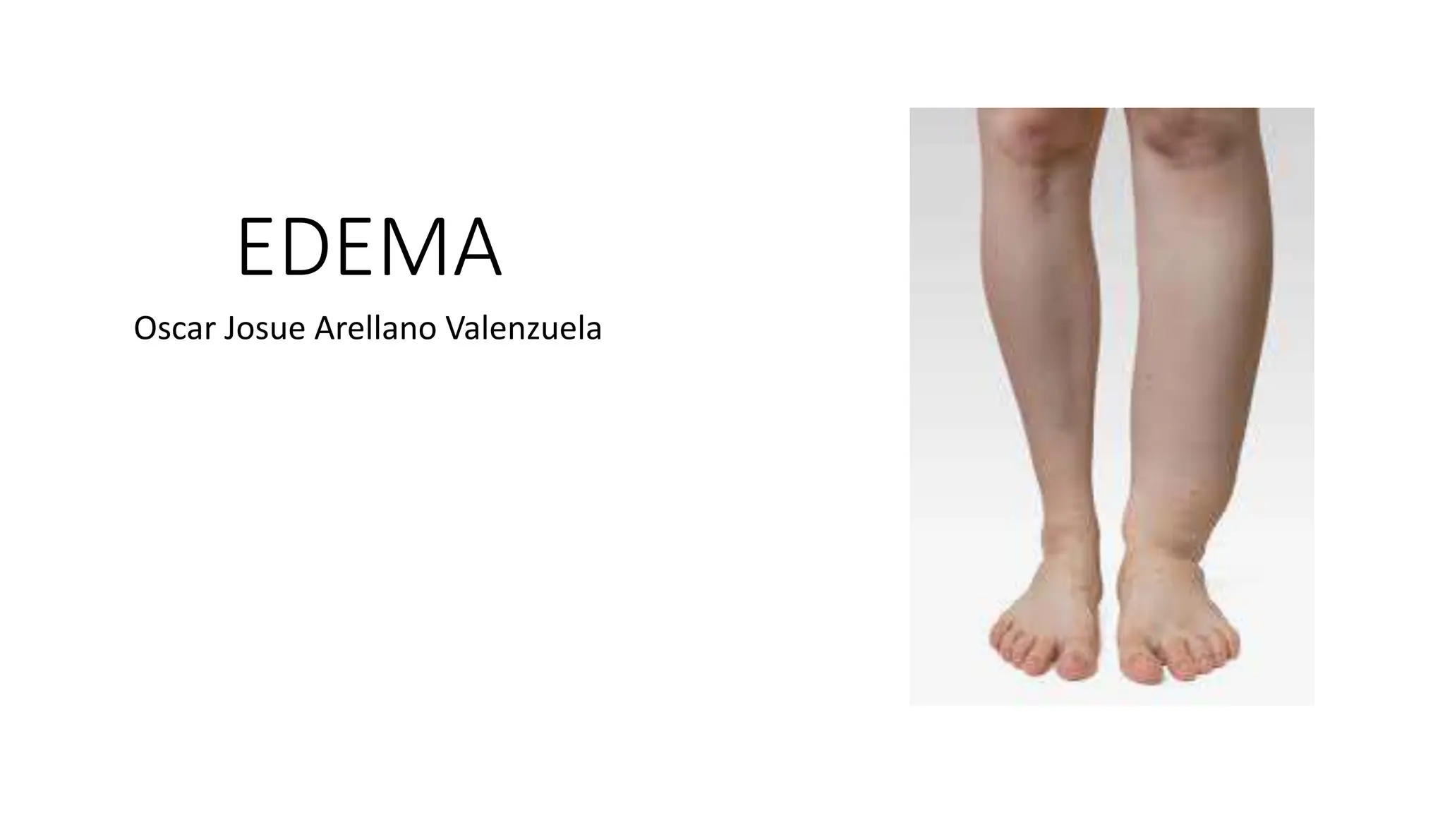 edema.pptx trabajo para que las personas | PPTX | Women\'s Health ...