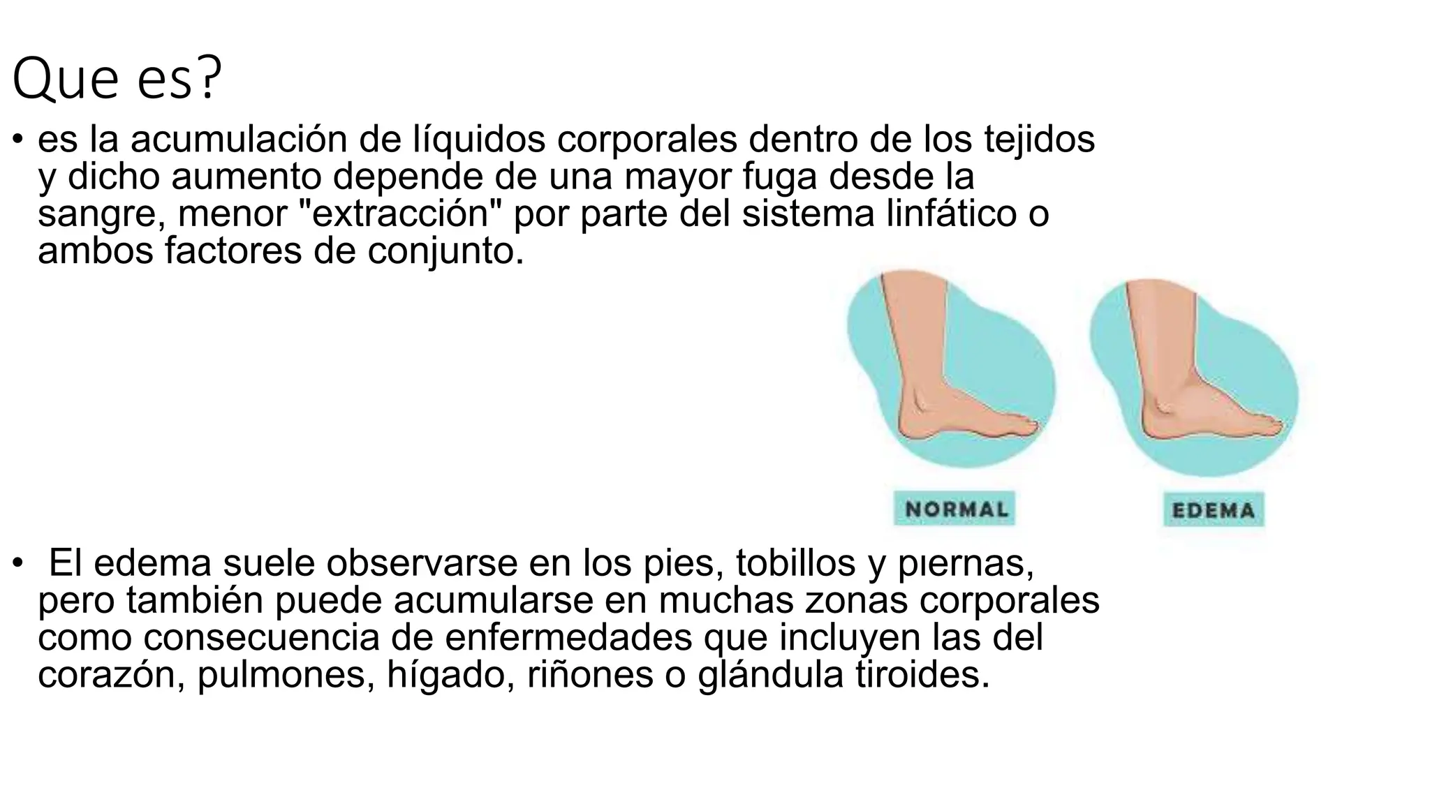 edema.pptx trabajo para que las personas | PPTX | Women\'s Health ...