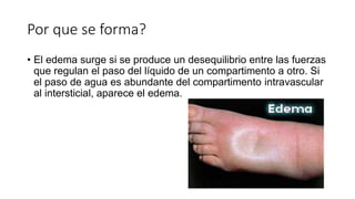 edema.pptx trabajo para que las personas | PPTX