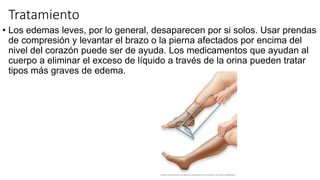 edema.pptx trabajo para que las personas | PPTX