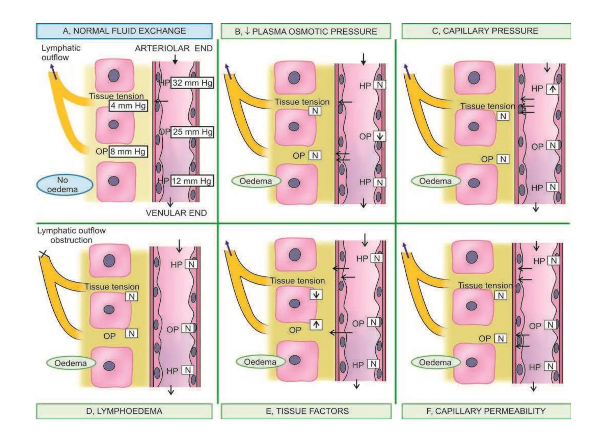 EDEMA, oedema, mechanism of edema, types | PPTX