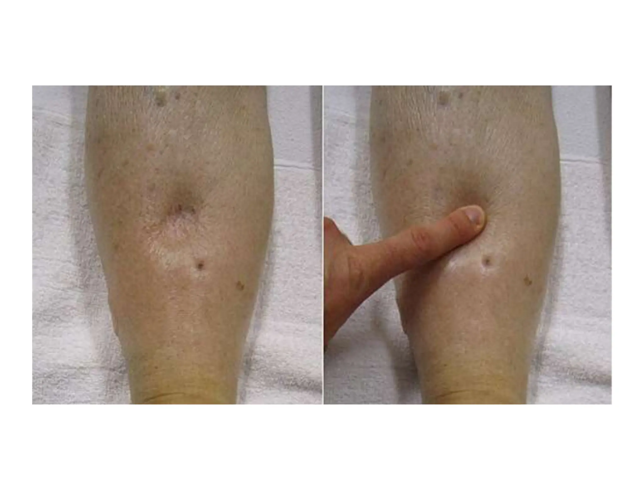 EDEMA, oedema, mechanism of edema, types | PPTX | Chemistry | Science