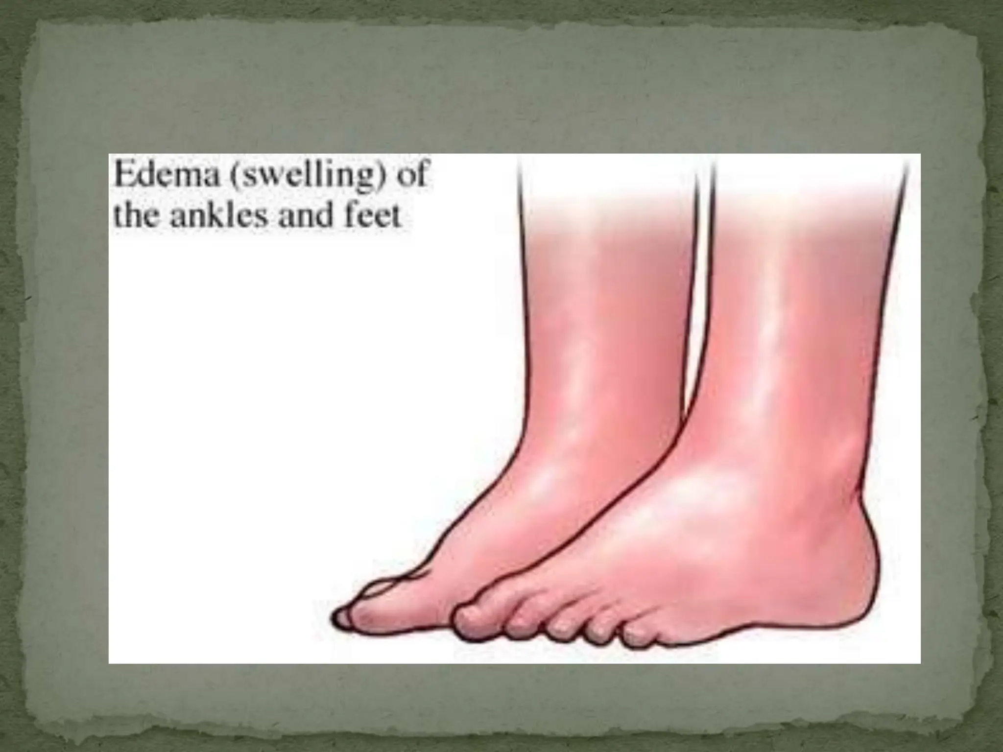 Edema.111111111111111111111111111111pptx | PPT