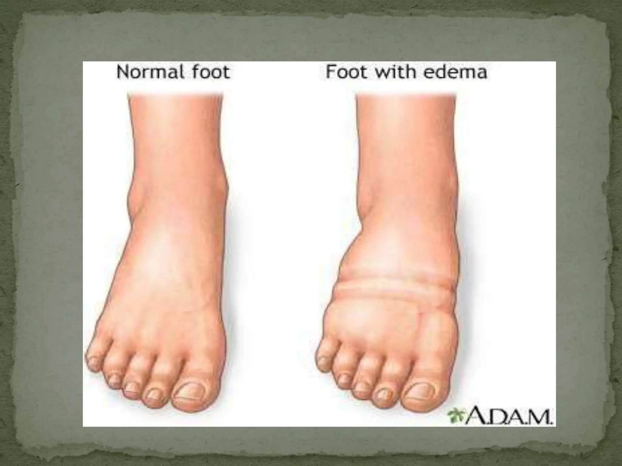 Edema.111111111111111111111111111111pptx | PPT