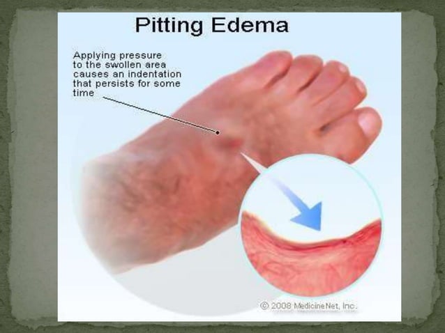 Edema.111111111111111111111111111111pptx | PPT