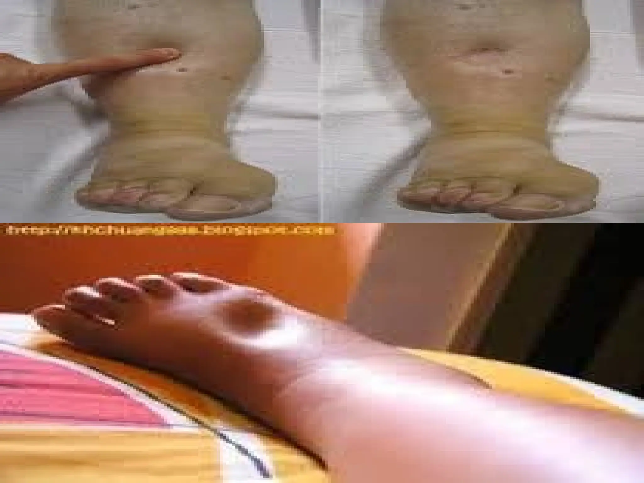 edema.ppt edema.ppt edema.ppt edema.pptedema.ppt