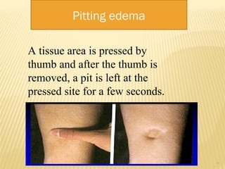 edema.ppt edema.ppt edema.ppt edema.pptedema.ppt