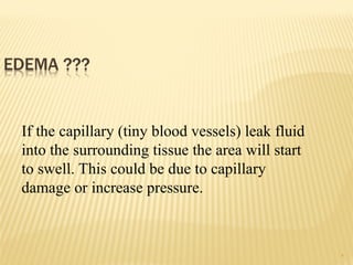 edema.ppt edema.ppt edema.ppt edema.pptedema.ppt