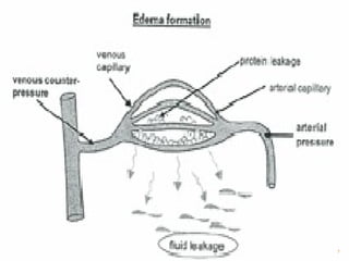 edema.ppt edema.ppt edema.ppt edema.pptedema.ppt