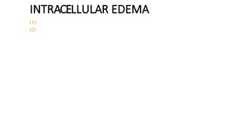 edema @ ppt 2212weerwqrqwr3eqrewrerrrrrrrrer | PPT